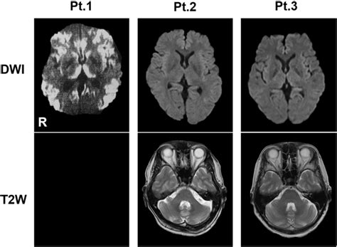 Brain Mri On Admission Dwi Image In Patient 1 Dwi And T2w Image In