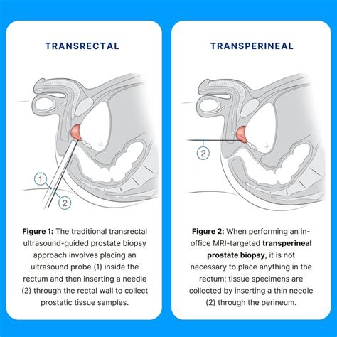 Transperineal Prostate Biopsy Vs Transrectal Benefits
