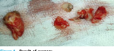 Figure 1 From Impacted Second Molar And Third Molar Mandibular Dextra