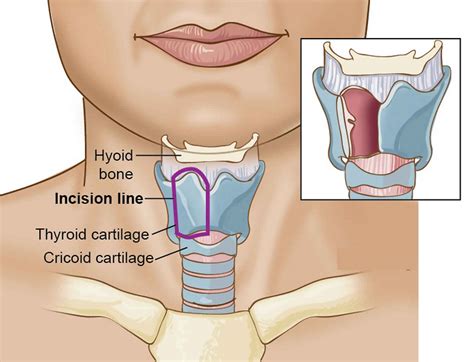 Total Or Partial Laryngectomy Procedure Complications Risks And Recovery