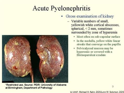 Pyelonephritis On Emaze