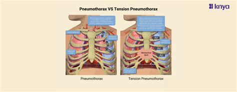 Pneumothorax Vs Tension Pneumothorax Collapsed Lung Vs Emergency Knya