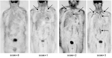 Examples Of The Semi Quantitative Scoring System Patients With No Or Download Scientific