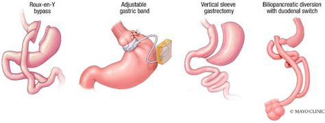 Sleeve Gastrectomy Vs Gastric Bypass