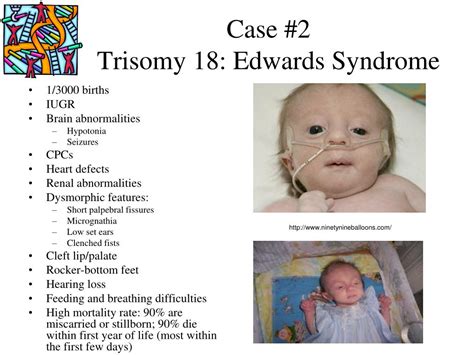Fetus With Complete Trisomy 18 Syndrome At Nicholas Mckillop Blog