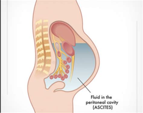 Fluid And Electrolytes Flashcards Quizlet