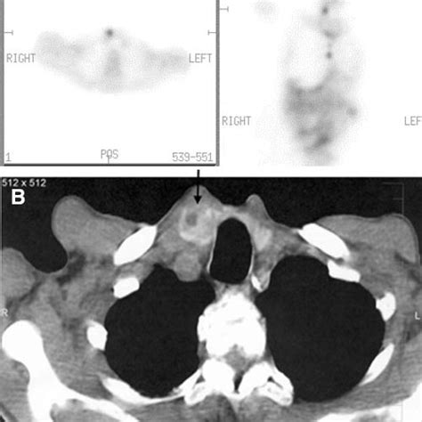 Stomach Uptake A Normal Uptake Mild Diffuse Uptake Arrows