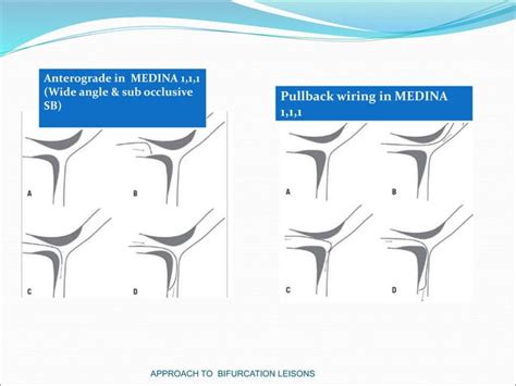 Approch To Bifurcation Lesion Pptx