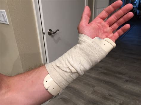How I Healed My Subluxating Extensor Carpi Ulnaris Tendon And Homemade Splint Instructions