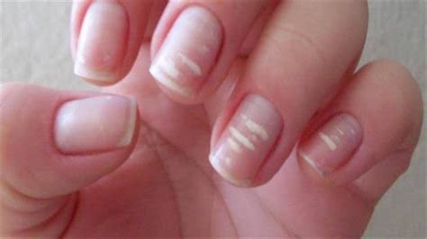 ليس نقص كالسيوم أسباب ظهور بقع بيضاء على أظافرك الكونسلتو