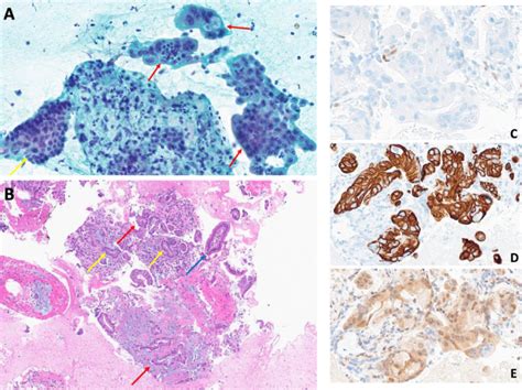 Distal Cholangiocarcinoma Case Report And Brief Review Of The
