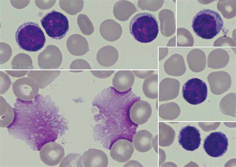 Chronic Active Epstein Barr Virus Infection As The Basis Of Neoplasm Development Transformation