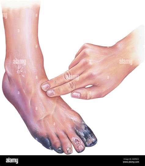Collection 98 Pictures Photos Of Diabetic Feet And Legs Updated