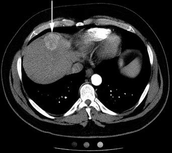 Incidental Detection Of Hepatocellular Carcinoma By Spect Myocardial
