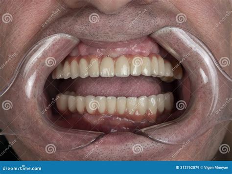Man Cavity Protected By Retractor Showing Perfect Teethimplants And
