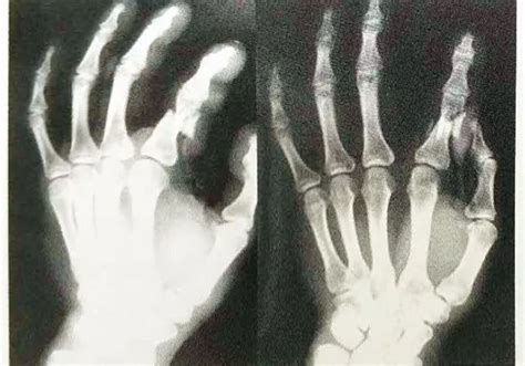 News Do You Know The Fixation Options For Metacarpal And Phalangeal Fractures