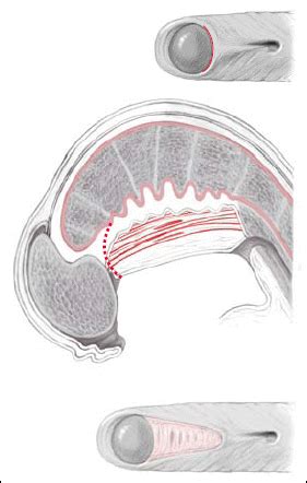 Hypospadias Surgery Hypospadie Zentrum Meatus Repair Prof Dr