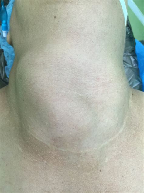 Difficult Total Thyroidectomy For Recurrent Multinodular Goiter Dr