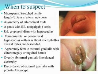 Ambiguousgenitalia Ppt Pptx