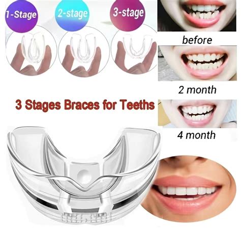 3 Stage Overnight Teeth Aligners 3 Phase Night Guard Braces Nuyu