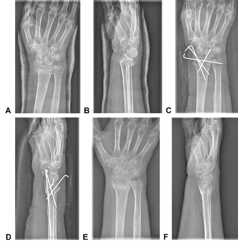 Table 1 From Percutaneous Distal Radius Ulna Pinning Of Distal Radius