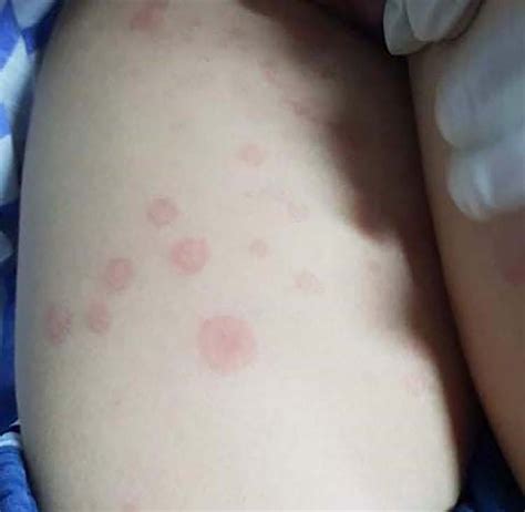 Erythematosus Rash On The Right Thigh With Mildly Elevated Borders