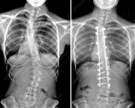 Scoliosis X Ray Before And After