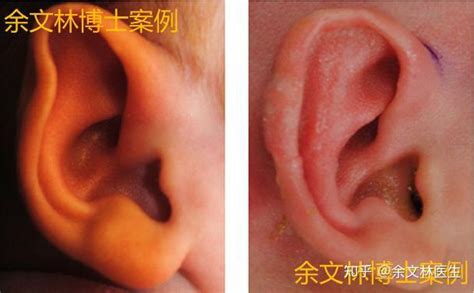 孩子耳朵不好看必须重视，猿耳畸形宝宝应尽早手术治疗 知乎