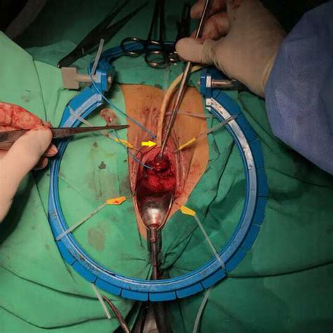 Intraoperative Photograph Of The Communication Of The Diverticulum With