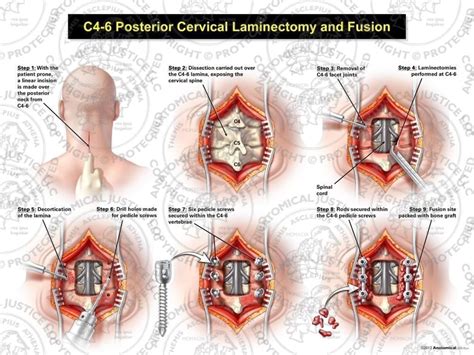 C4 6 Posterior Cervical Laminectomy And Fusion Stock Medical