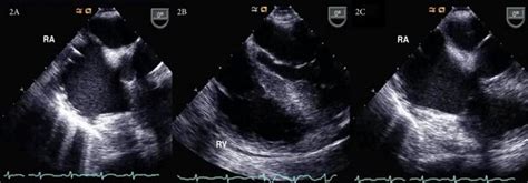 Intraoperative Tee Before Veno Arterial Ecmo Decannulation A Right