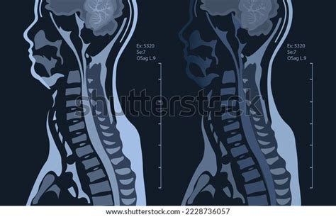 Mri Cervical Spine Without Contrast Mri Stock Vector Royalty Free