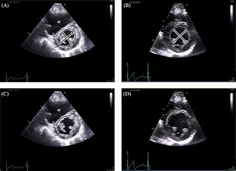 Assessment Of The Right Ventricle Function In Patients With Significant Tricuspid Regurgitation