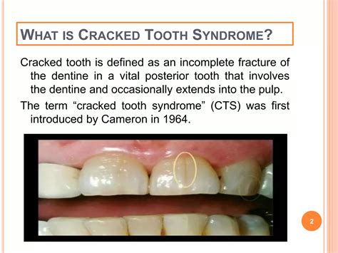 Cracked Tooth Syndrome Pptx