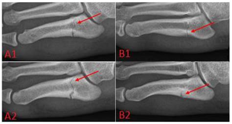 Analytical Stochastic And Experimental Solution Of The Osteosynthesis