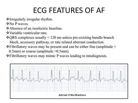 Atrial Fib And Flutter Pptx Heart And Cardiovascular Diseases