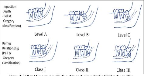 Figure 2 From Classification Of Impacted Mandibular Third Molars In A