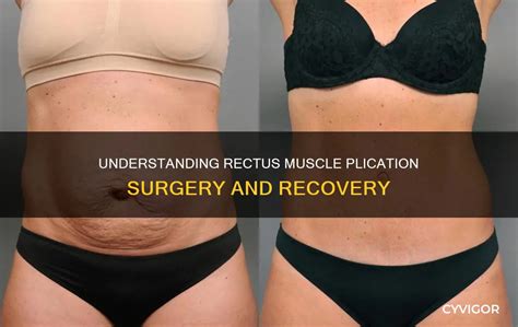 Understanding Rectus Muscle Plication Surgery And Recovery Cyvigor