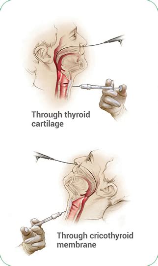 Prolaryn® Gel And Prolaryn® Plus Percutaneous Injection Guidelines
