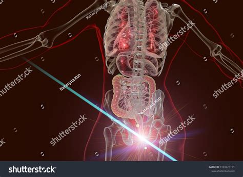 Hemorrhoids Treatment Prevention Concept 3d Illustration 스톡 일러스트