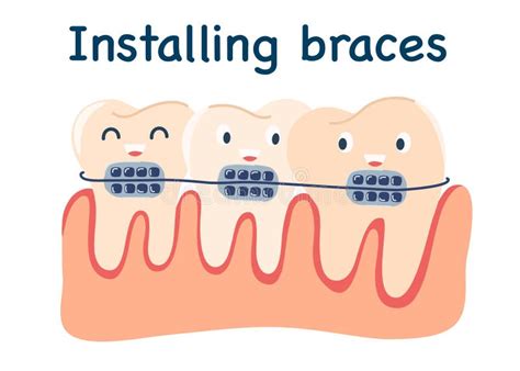 Cute Cartoon Teeth With Braces Installing Braces Stock Vector Illustration Of Person Health