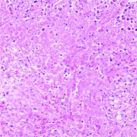 Hande Stain Showing Fibrinoid Necrosis Of The Vessels Walls And Extensive Download Scientific