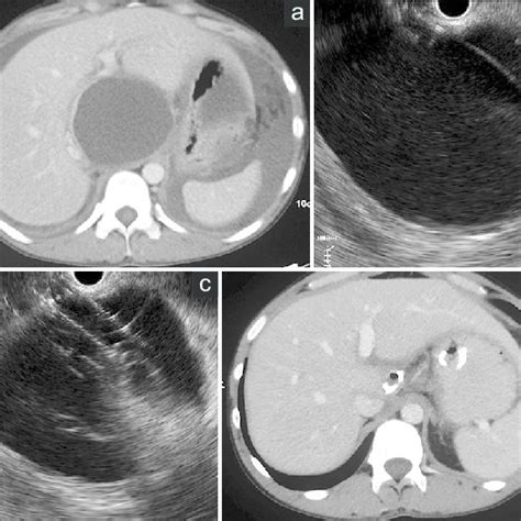 Arterial Phase Ct Shows Arterial Enhancement Pattern Of The Vascular