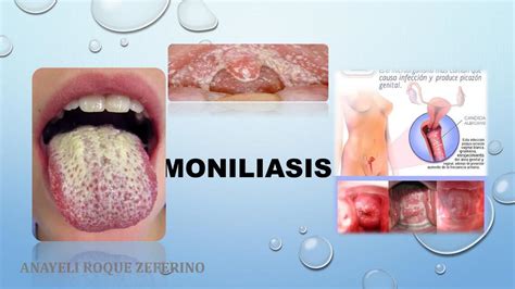 Moniliasis Miranda Udocz