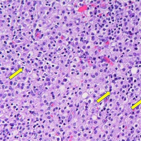 Absence Of A Cecal Mass On Colonoscopy Patent Appendiceal Orifice
