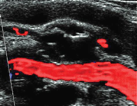 Color Doppler Ultrasonography Showing Walled Cystic Lesion In The