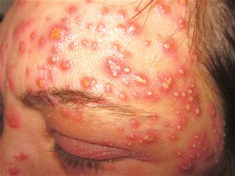 Pruritic Pustules