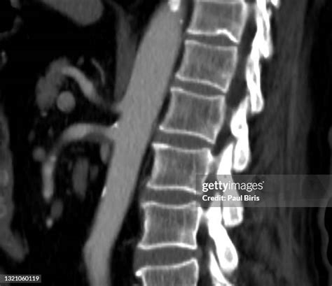 Arterial Calcification Photos And Premium High Res Pictures Getty Images