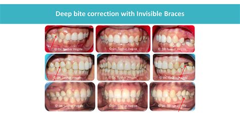 Patient Cases Asha Advanced Dentistry