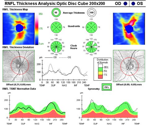 Optical Coherence Tomography In Neuro Ophthalmology Intechopen